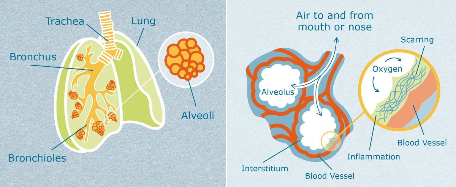 Interstitial Lung Disease: What Patients Need to Know